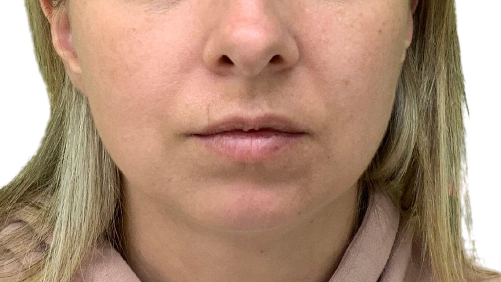 Revitalise Your Smile: Lip Flip Anti-Wrinkle Injections at Nova Clinic ...