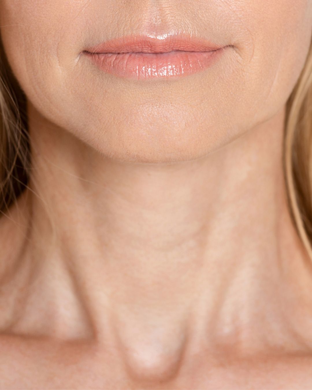 Rejuvenate Your Neck with Anti-Wrinkle Injections - Nova Clinic – Nova ...