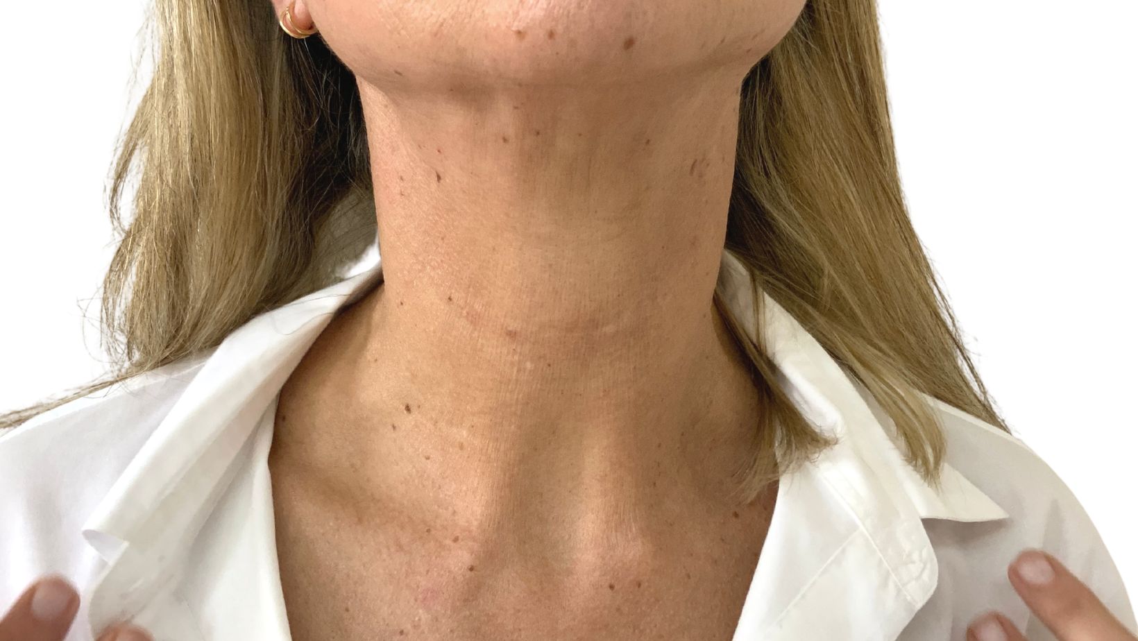 Rejuvenate Your Look | Neckline Fillers at Nova Cosmetic Clinic