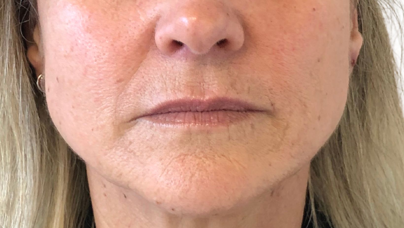 Lip Line Fillers: Smooth Lips & Youthful Look | Sydney's Nova Clinic ...