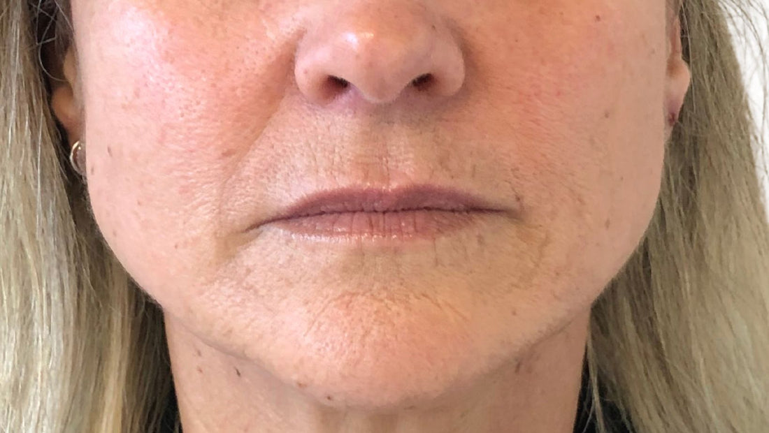 Smoker's Lines Anti-Wrinkle Injections | Nova Cosmetic Clinic