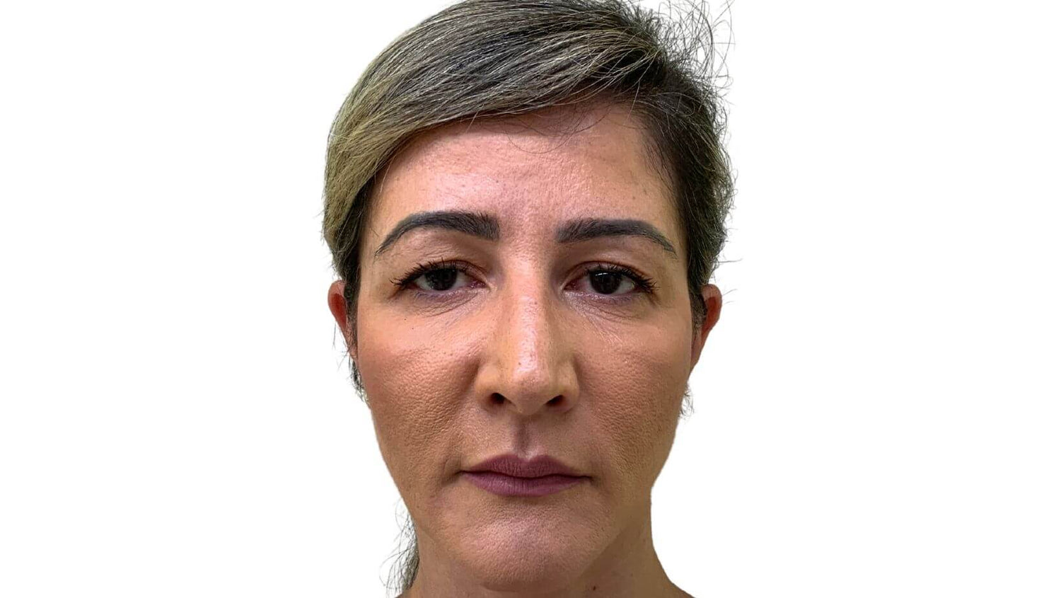 Temple Fillers in Sydney: Restore Volume & Contour for a Youthful Look ...