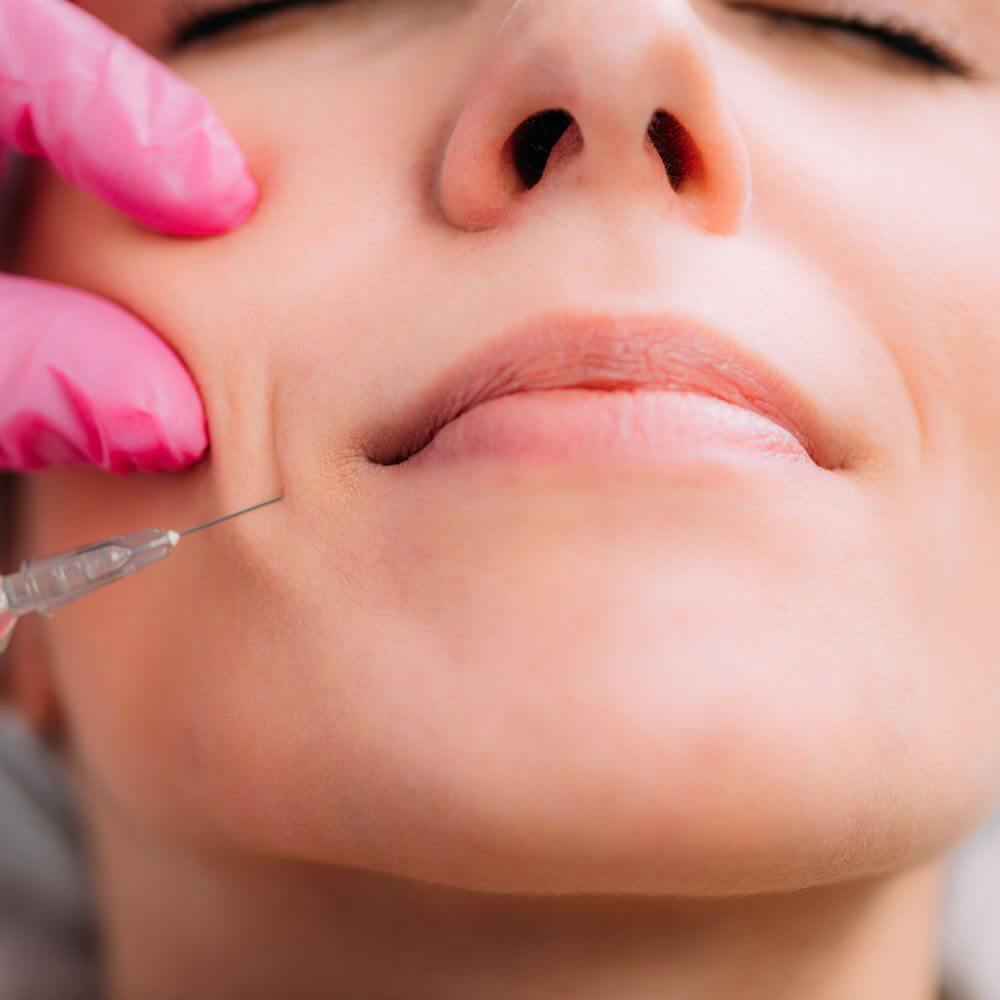 Gummy Smile Treatment Anti Wrinkle Injections At Nova Clinic Nova