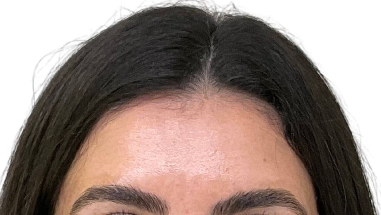 Forehead Lines Anti-Wrinkle Injections | Nova Cosmetic Clinic Sydney CBD