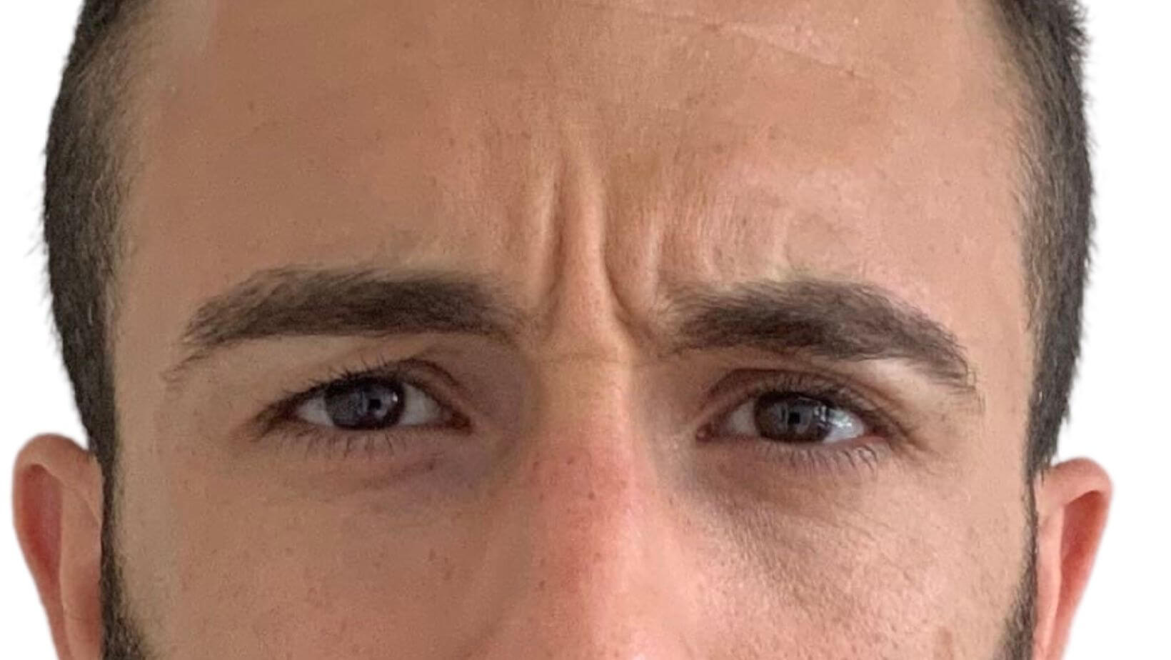 Effective Frown Line Anti-Wrinkle Injections | Nova Cosmetic Clinic