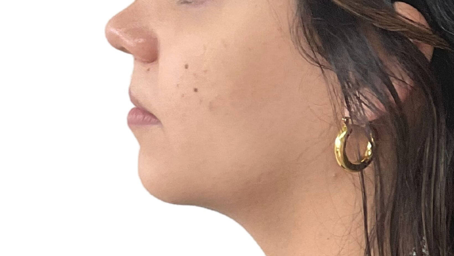 Enhance Your Jawline with Premium Jawline Fillers | Nova Cosmetic Clinic